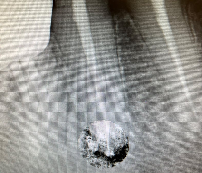 BioRoot Flow: a new root canal sealer in a syringe based on ABS Technology